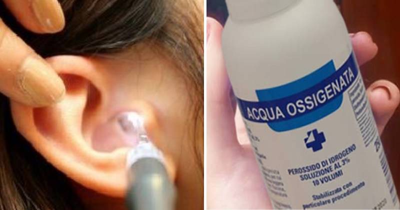 Cerume in eccesso: ecco come eliminarlo con l'acqua ossigenata