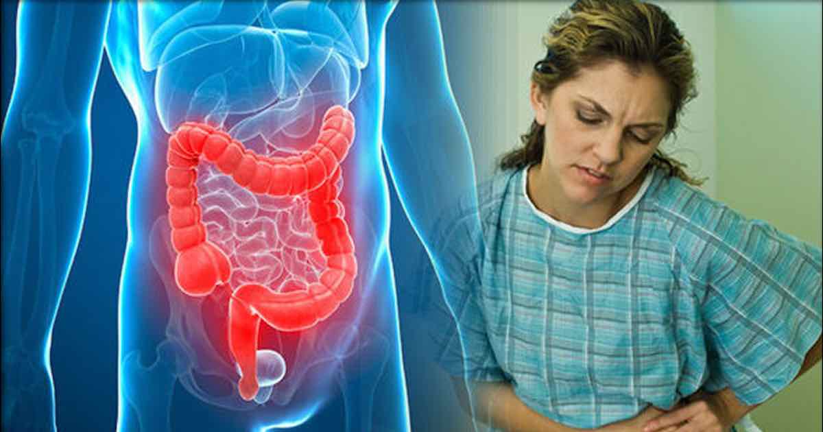 Colite: 6 alimenti da evitare per non peggiorare i sintomi